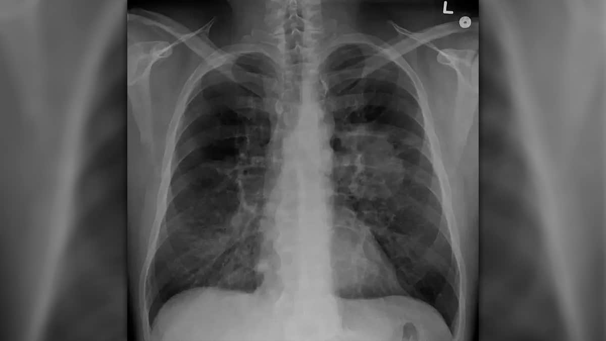 Cancer De Pulmao Vs Pneumonia Raio X SciELO Brasil Radiologia Do