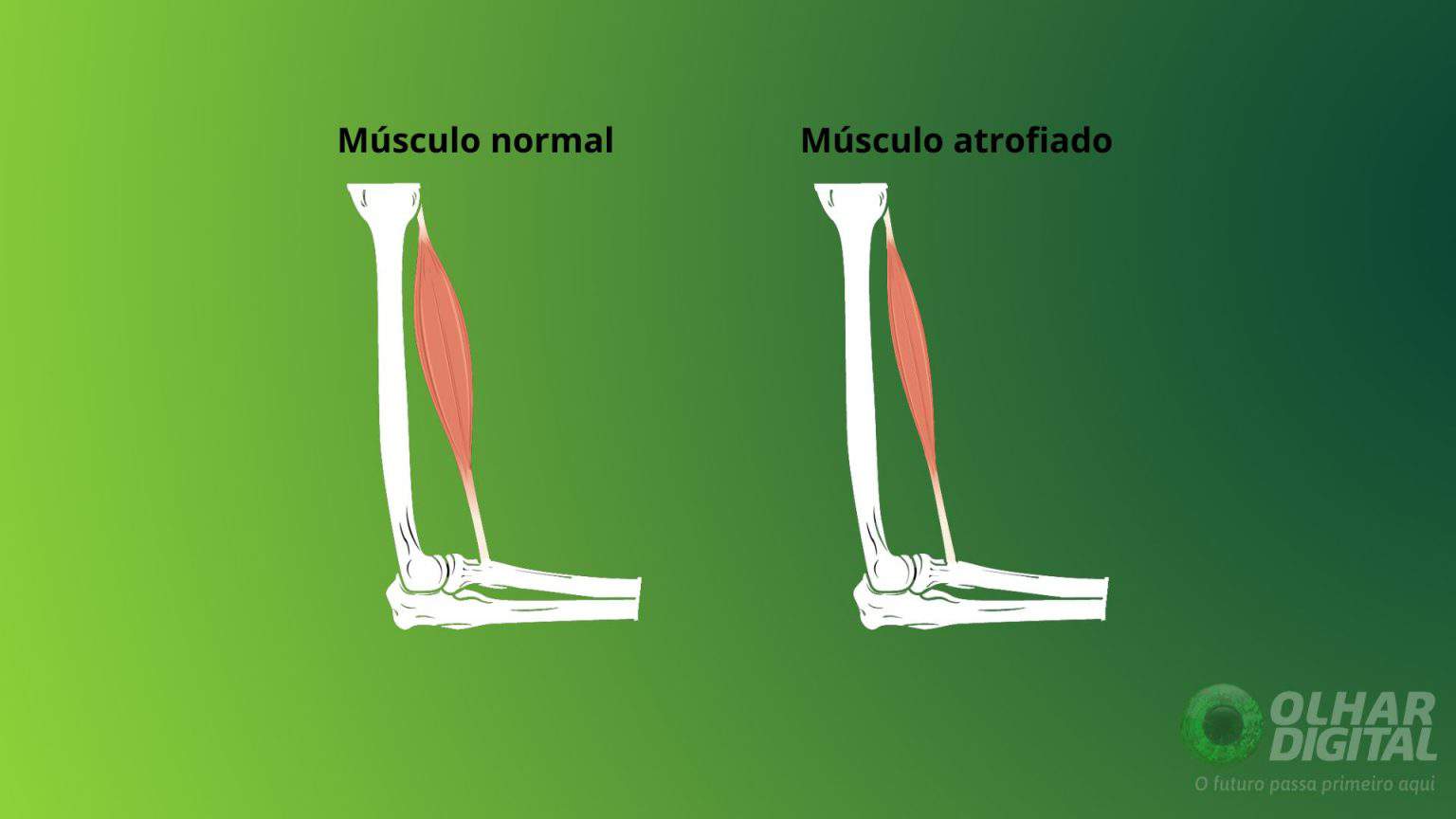 Atrofia e hipertrofia muscular: entenda como esses processos impactam ...