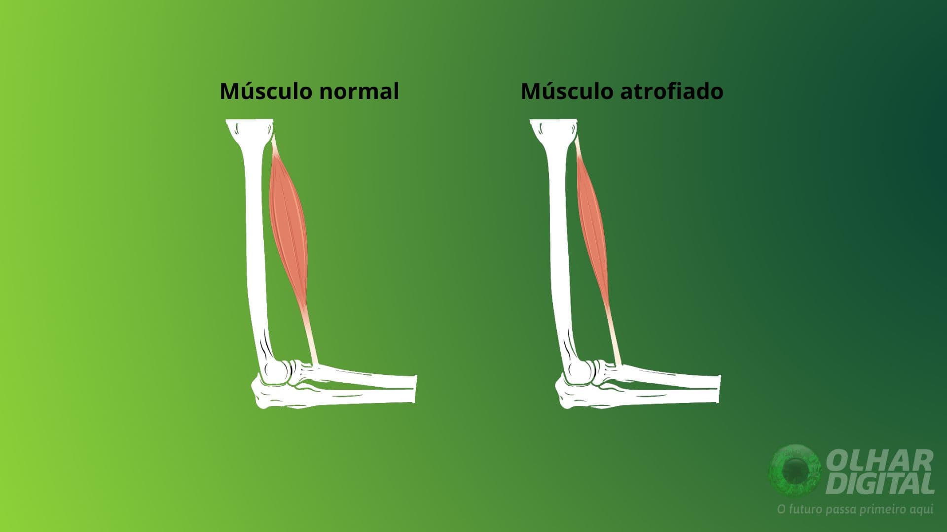 Atrofia e hipertrofia muscular: entenda como esses processos impactam ...