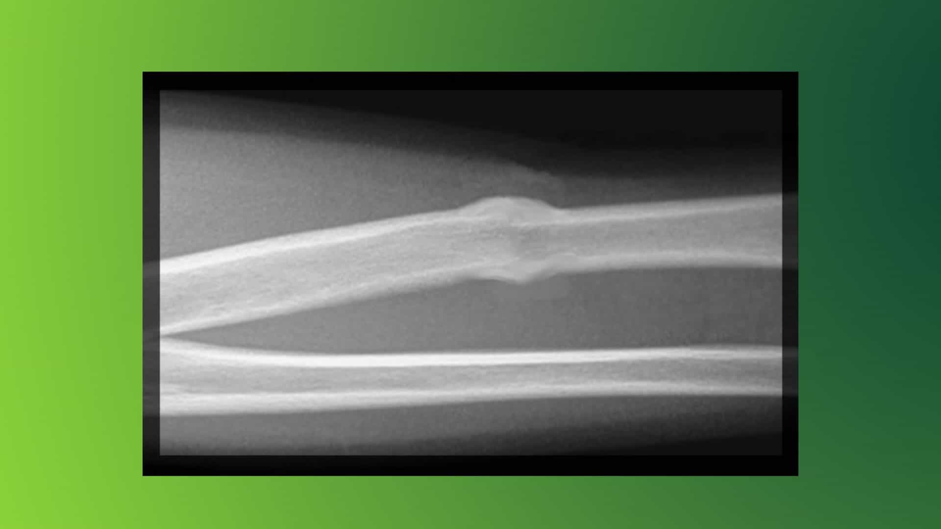 Ossos quebrados: 8 mitos e verdades que você precisa conhecer - Olhar ...