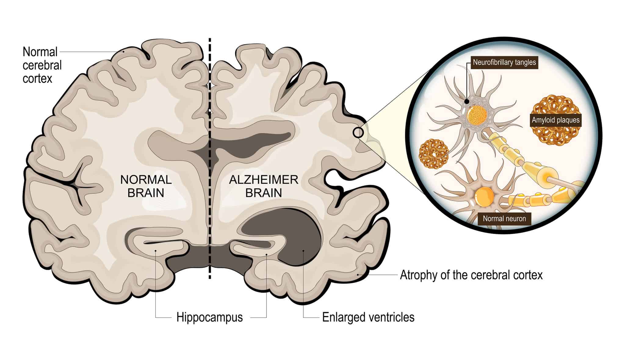 Como funciona o Kisunla, novo tratamento para Alzheimer?