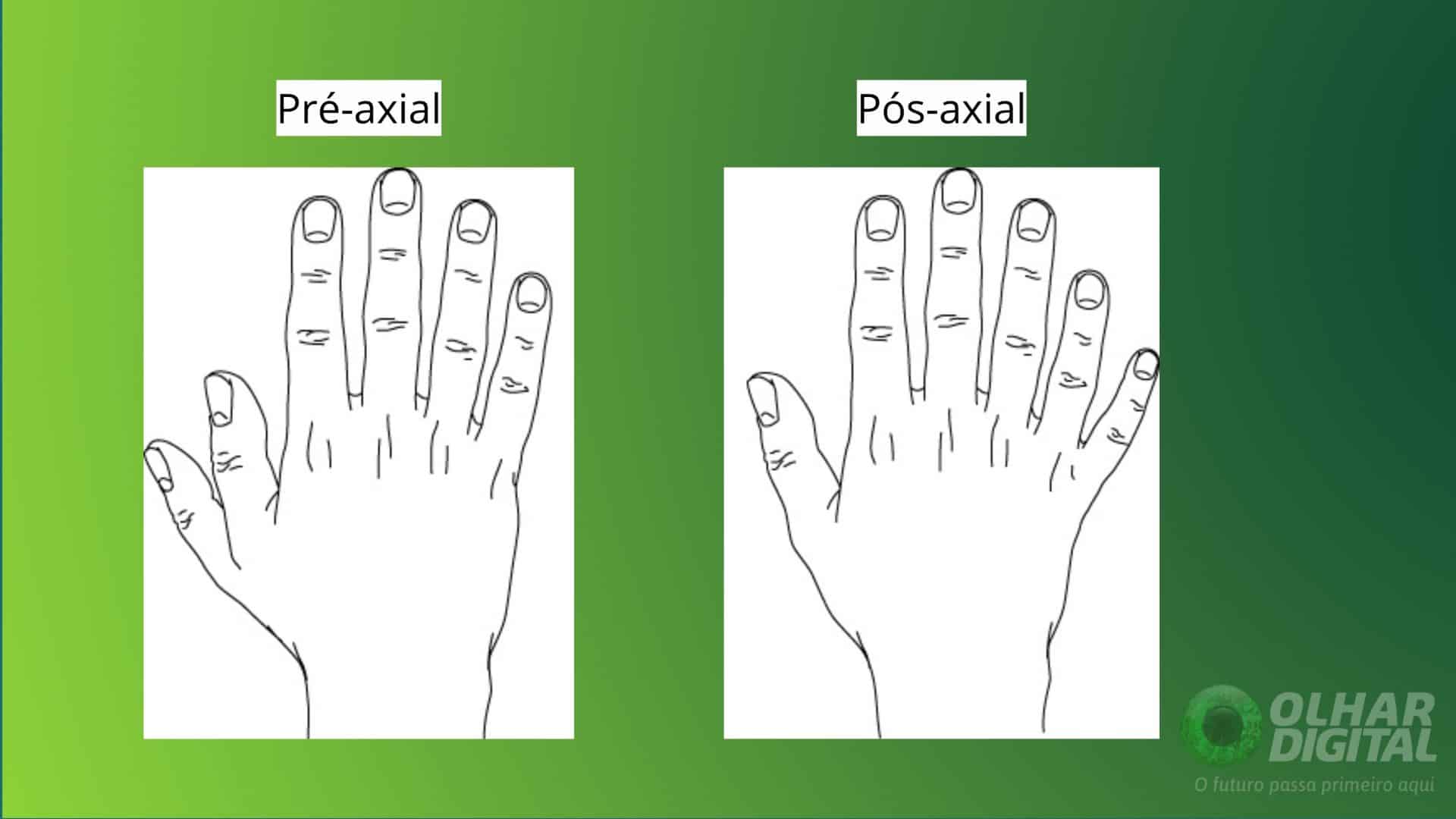 O que é polidactilia? Entenda por que algumas pessoas têm dedos a mais