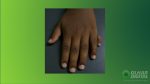 O que é polidactilia? Entenda por que algumas pessoas têm dedos a mais