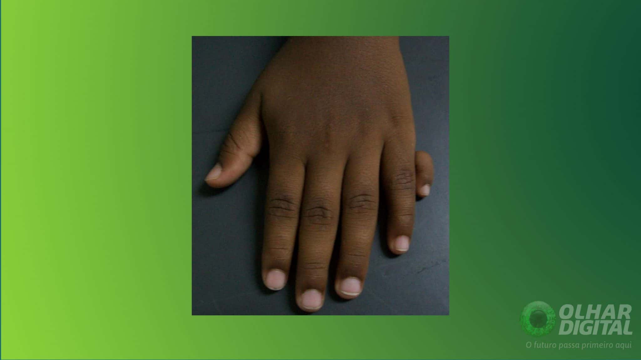 O que é polidactilia? Entenda por que algumas pessoas têm dedos a mais