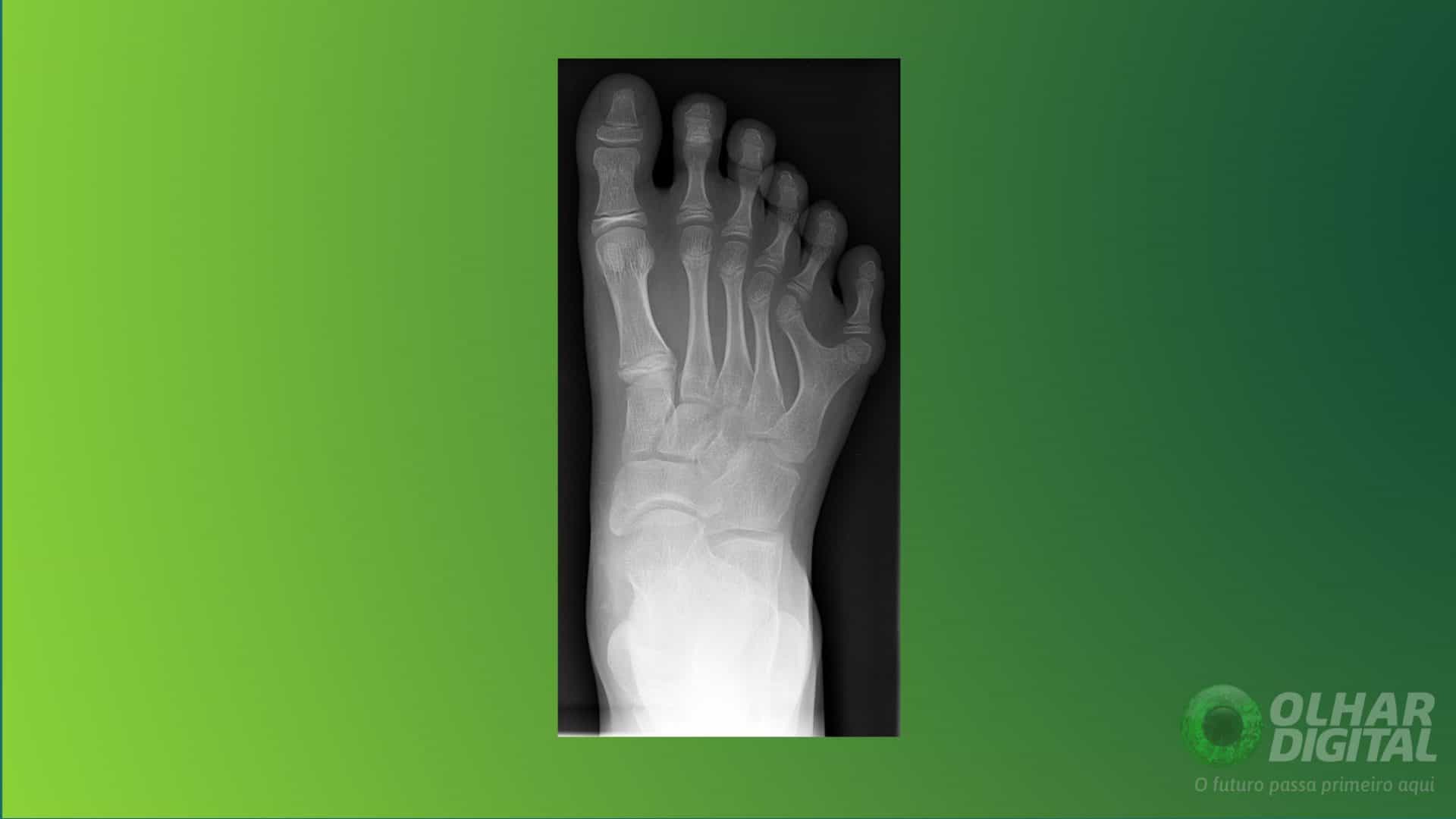 O que é polidactilia? Entenda por que algumas pessoas têm dedos a mais