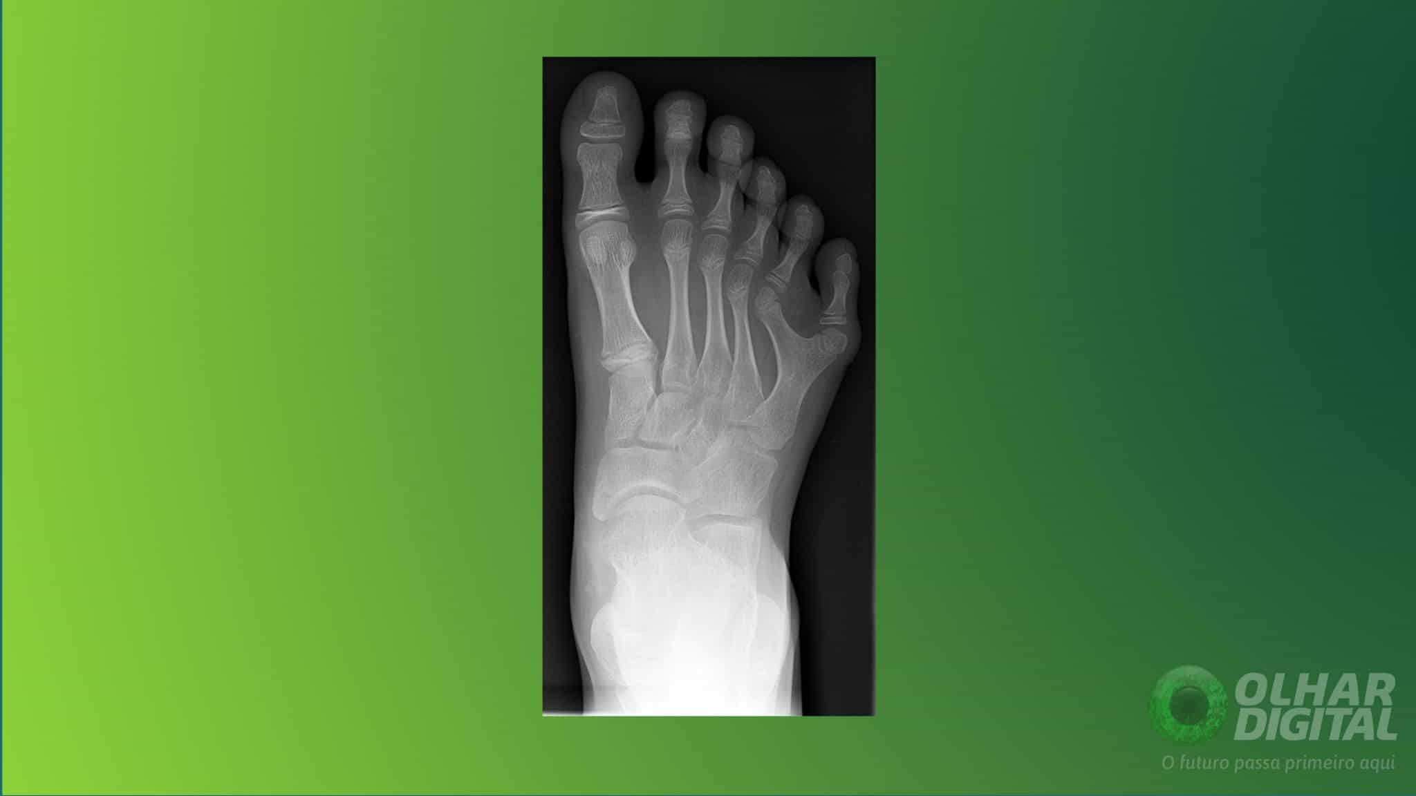 O que é polidactilia? Entenda por que algumas pessoas têm dedos a mais