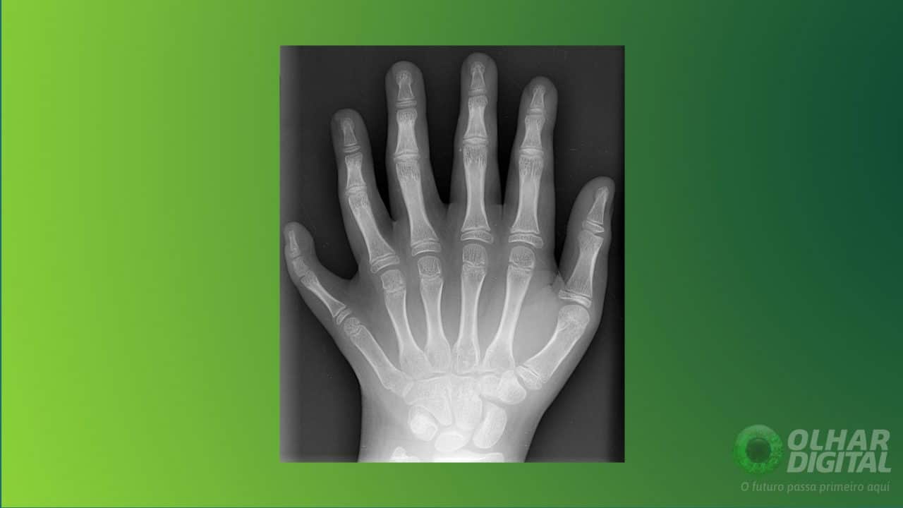 O que é polidactilia? Entenda por que algumas pessoas têm dedos a mais
