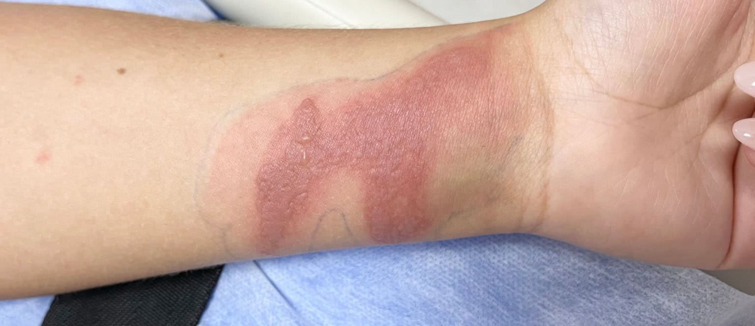 O que é celulite infecciosa? Conheça sintomas e formas de tratamento