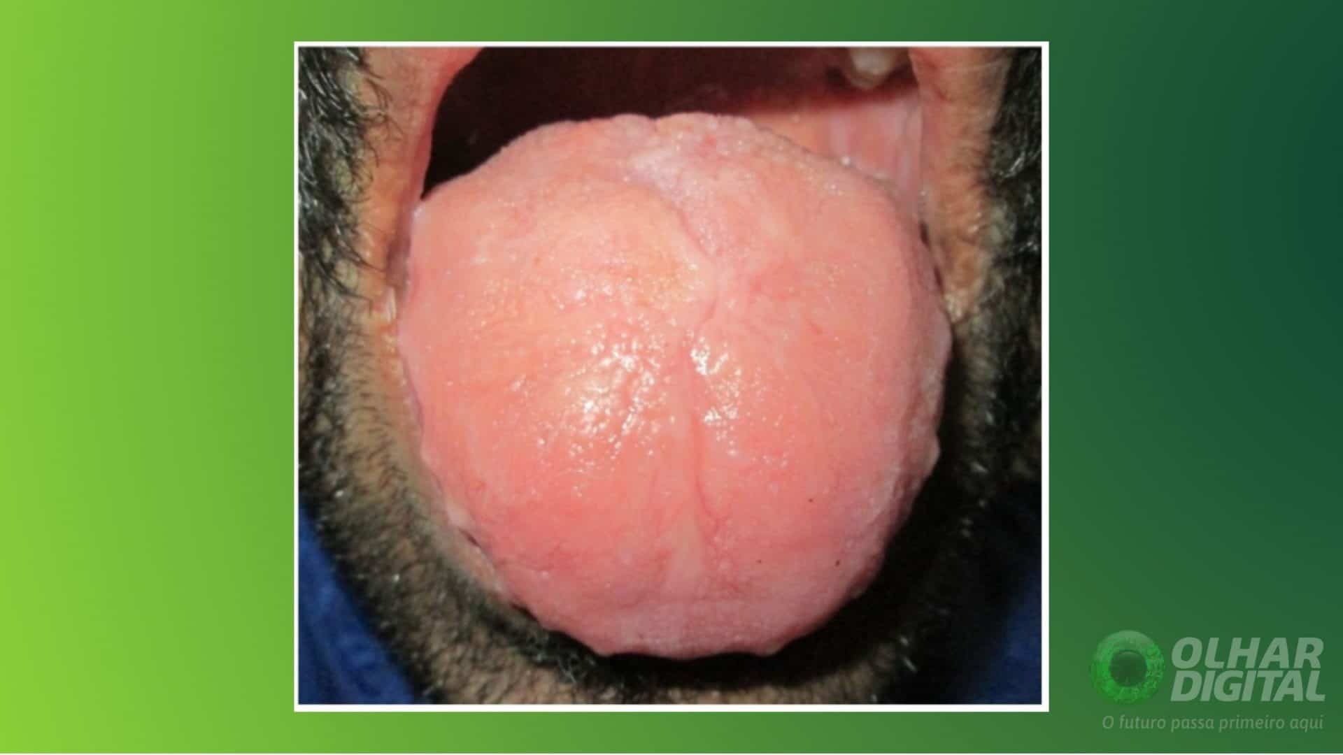 Como e por que a língua indica problemas de saúde? - Olhar Digital
